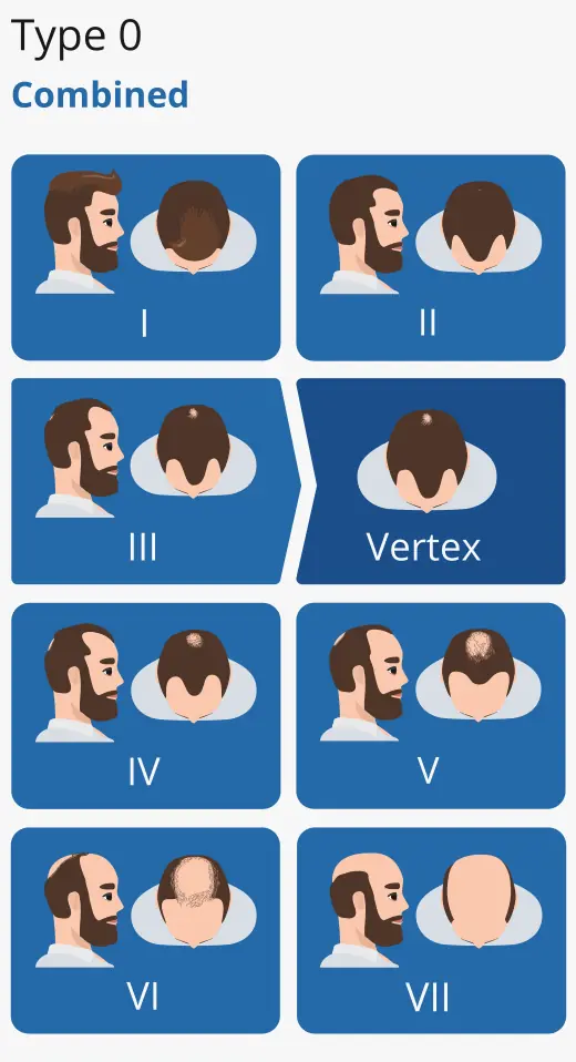 The 7 Hair Loss Stages and Our Innovative Scale | Elithair