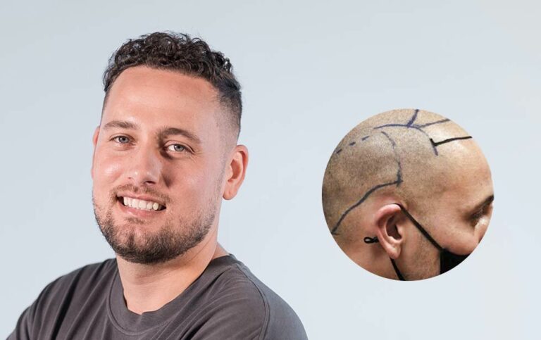 Hair Transplant Costs: Our Prices for 2024 | Elithair